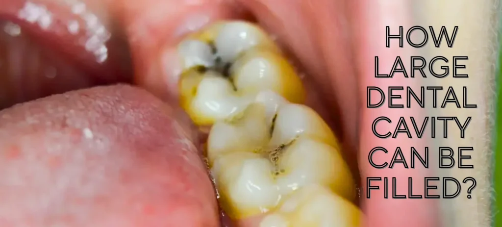How Large Dental Cavity Can Be Filled? - Daily Dentists
